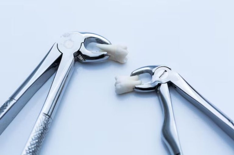 What Happens After a Tooth Extraction?